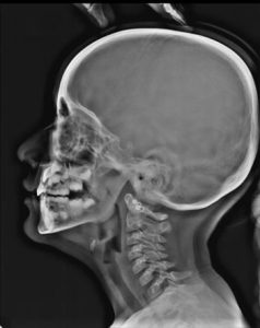 How to Palpate the Mastoid Bone Behind Ear - Sharing is Power | Ngumpi
